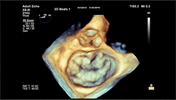 Echo – Southampton Cardiac Anaesthesia